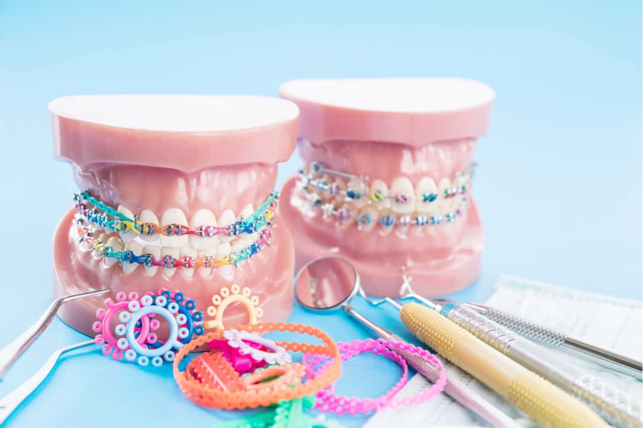 Flared Teeth After Braces | Cosmetic and Laser Dentistry - Dr Loos